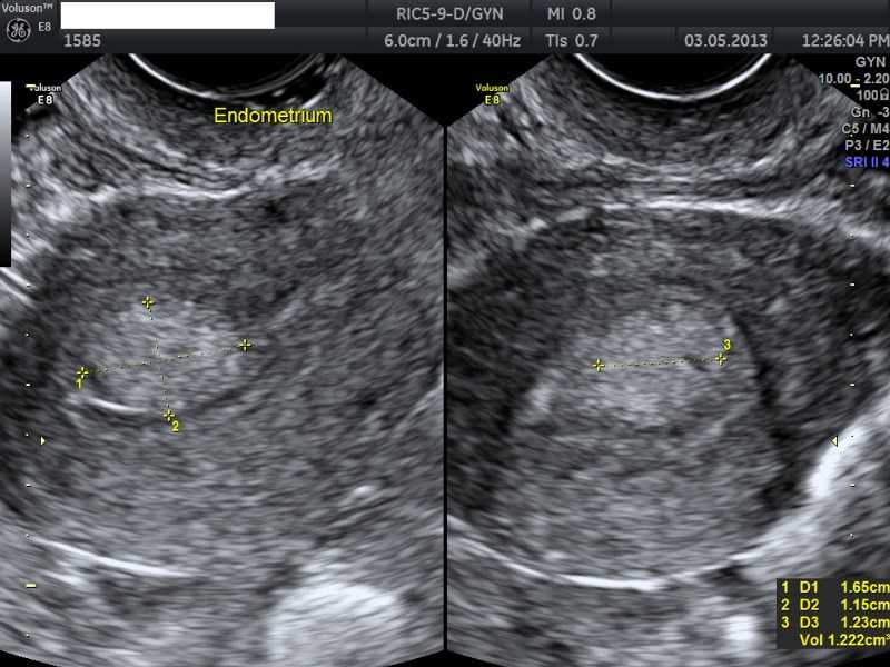 Pelvic Ultrasound - POGU