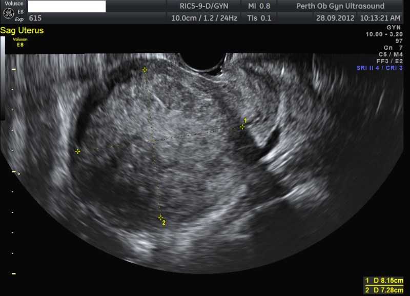 Pelvic Ultrasound - POGU
