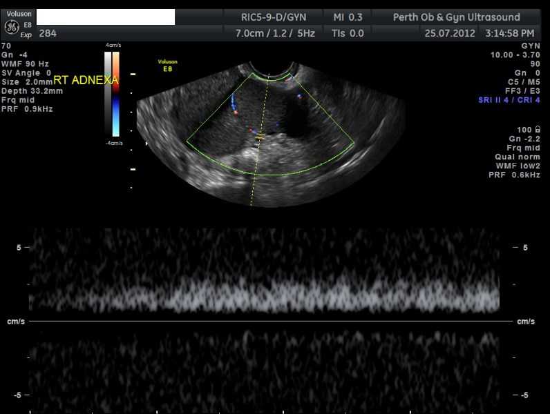 Pelvic Ultrasound - POGU