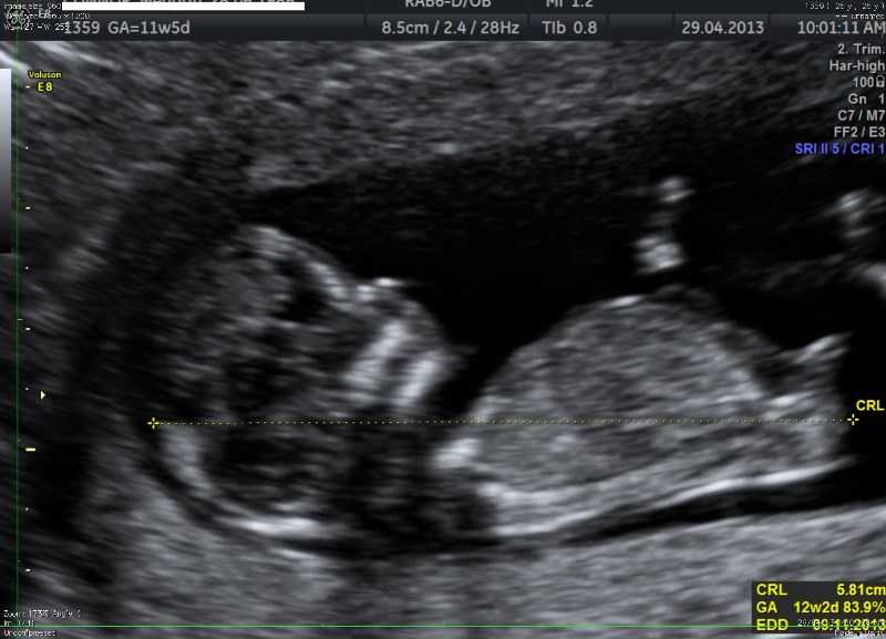 First Trimester Screening Gallery - POGU