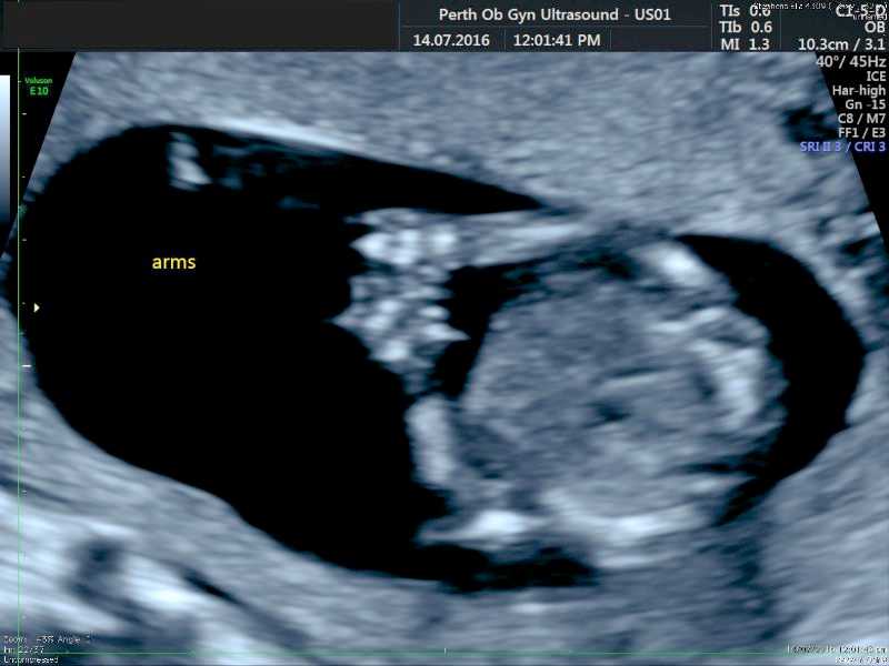 First Trimester Screening Gallery - POGU