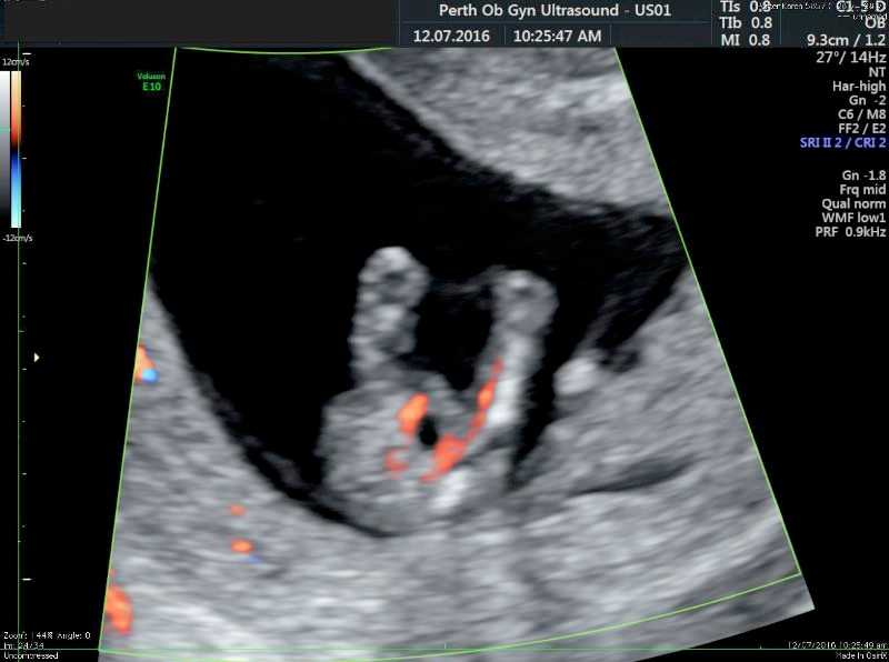 First Trimester Screening Gallery - POGU