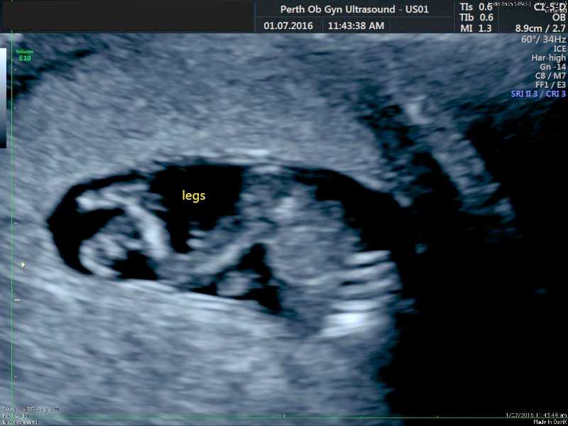 First Trimester Screening Gallery - POGU