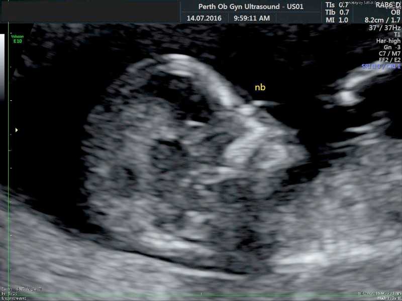 First Trimester Screening Gallery - POGU