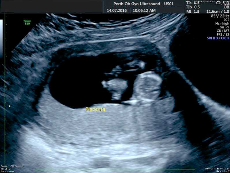 First Trimester Screening Gallery - POGU