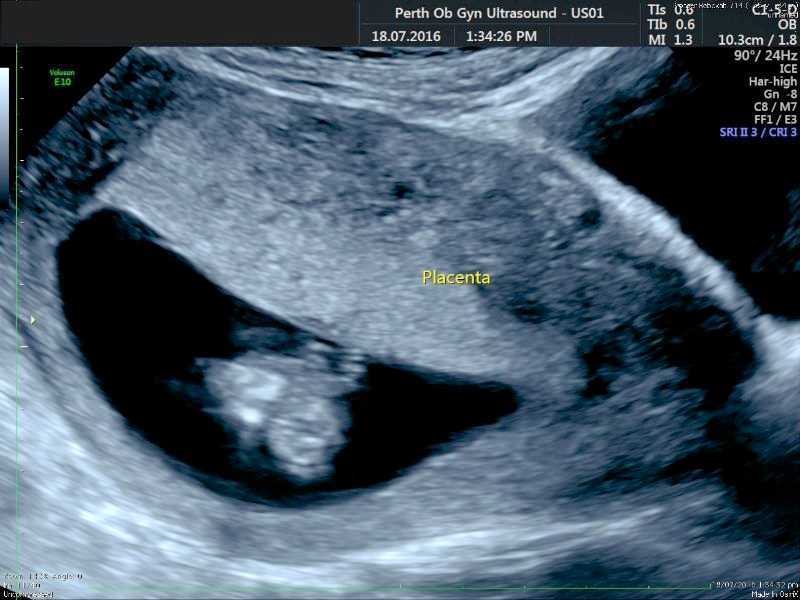 First Trimester Screening Gallery - POGU
