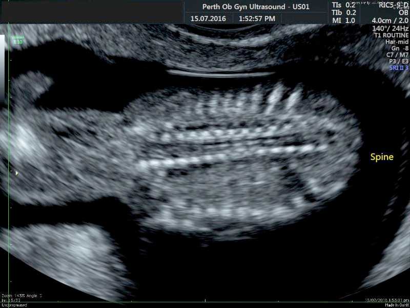 First Trimester Screening Gallery - POGU