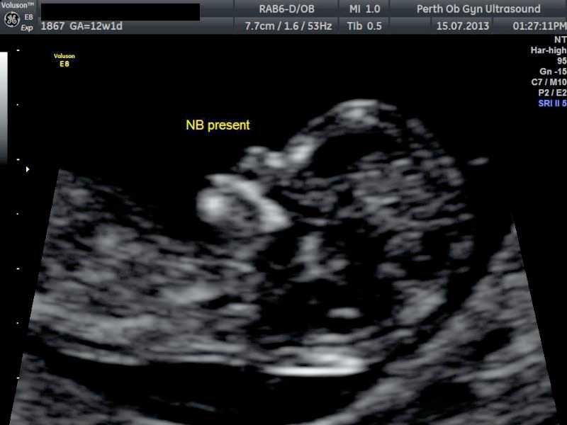 First Trimester Screening Gallery - POGU