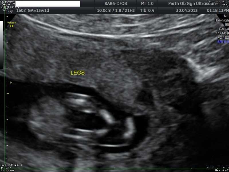 First Trimester Screening Gallery - POGU