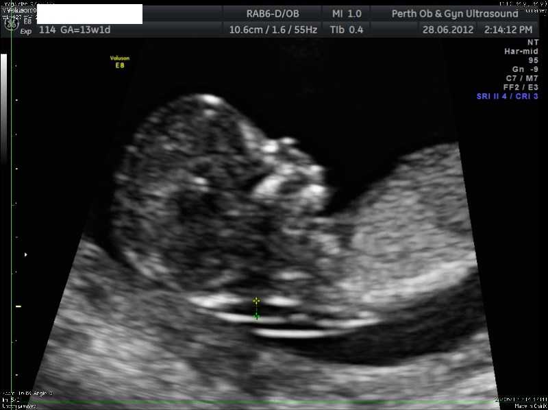 First Trimester Screening Gallery - POGU