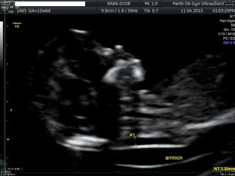 First Trimester Screening Gallery - POGU