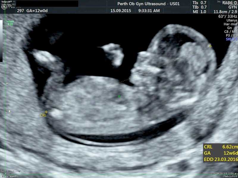 First Trimester Screening Gallery - POGU