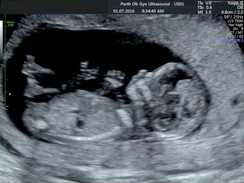 First Trimester Screening Gallery - POGU