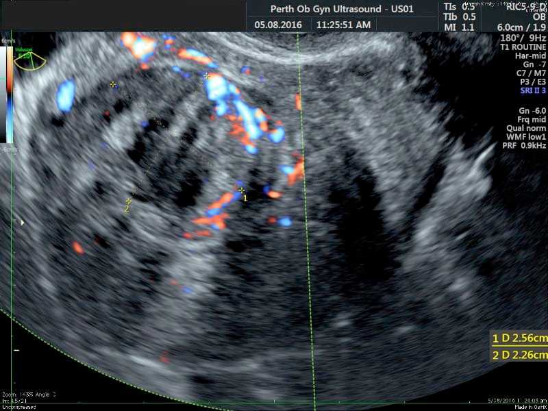 Early pregnancy scan gallery - POGU