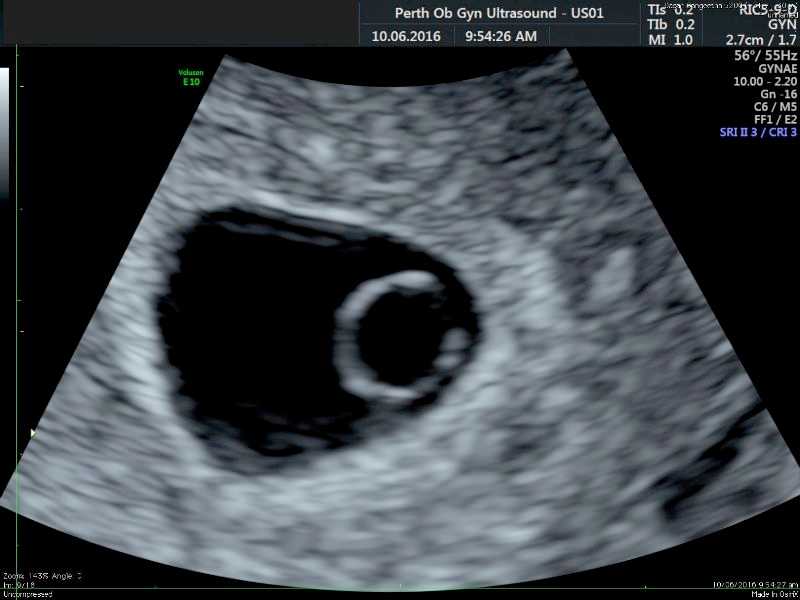 Early pregnancy scan gallery - POGU