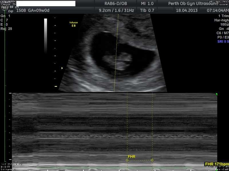 Early pregnancy scan gallery - POGU