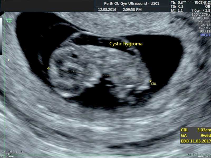 Early pregnancy scan gallery - POGU