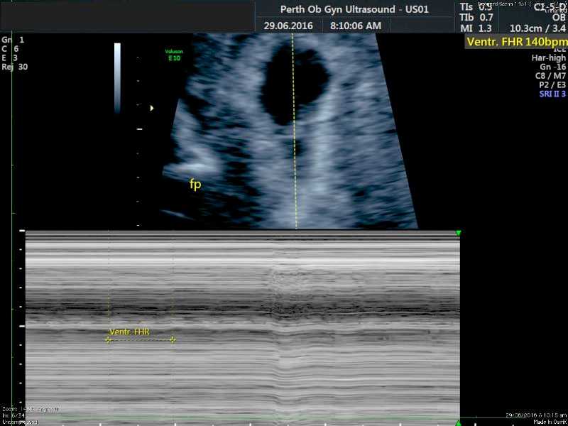 Early pregnancy scan gallery - POGU