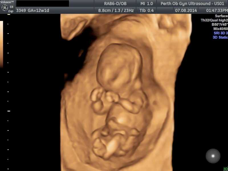 First Trimester Screening Gallery - POGU
