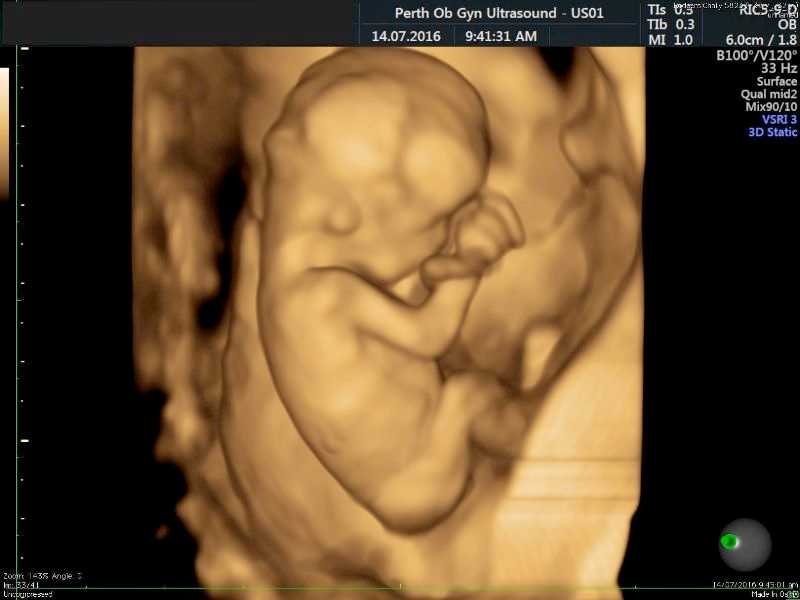 First Trimester Screening Gallery - POGU