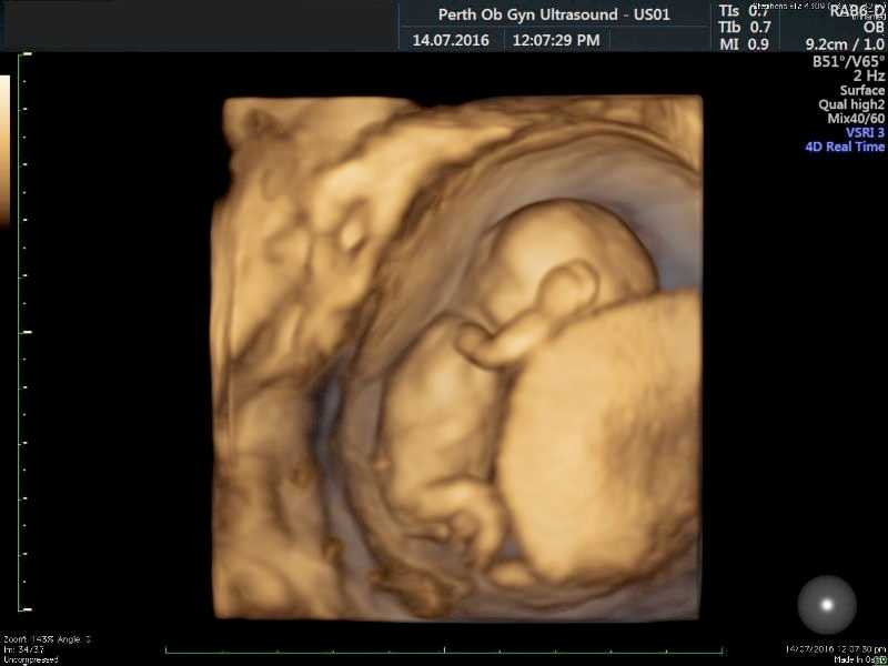 First Trimester Screening Gallery - POGU