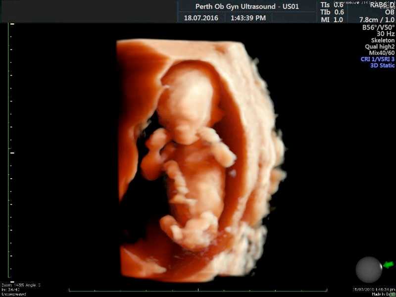 First Trimester Screening Gallery - POGU