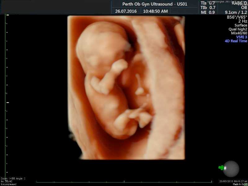 First Trimester Screening Gallery - POGU