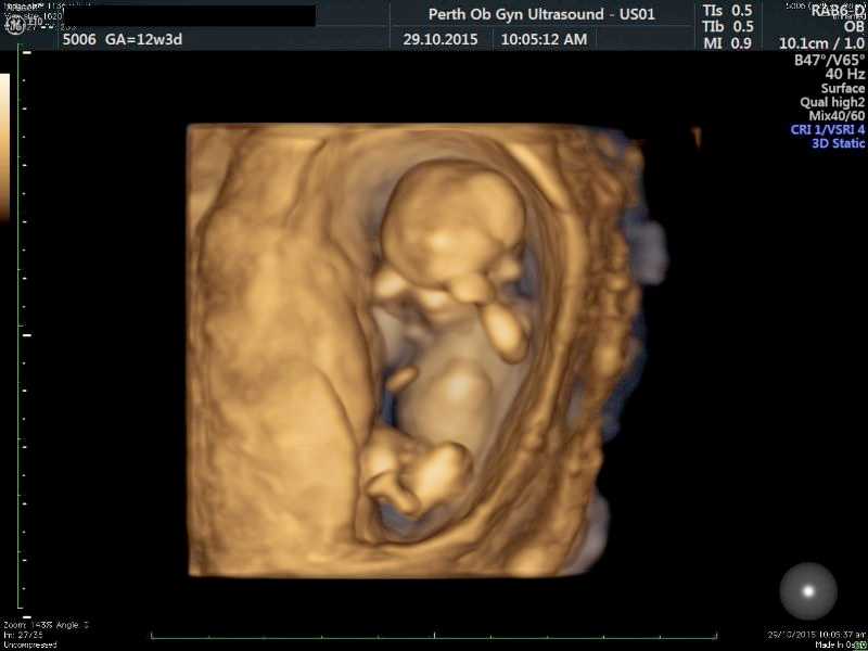 First Trimester Screening Gallery - POGU
