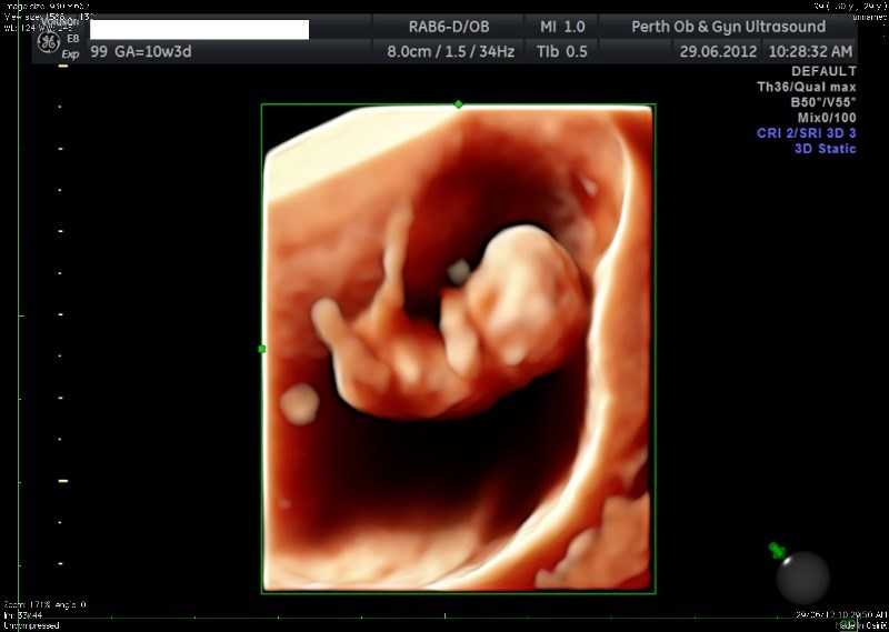 Early pregnancy scan gallery - POGU