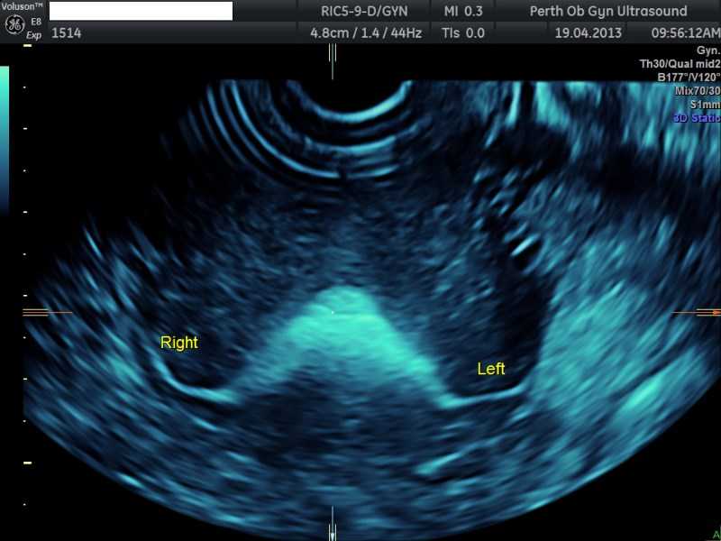 HyCoSy / HyFoSy - POGU