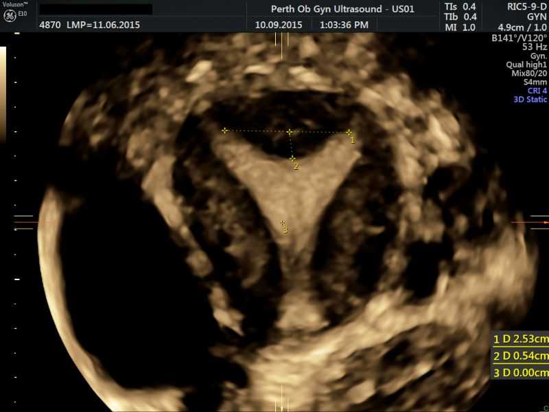 Pelvic Ultrasound - POGU