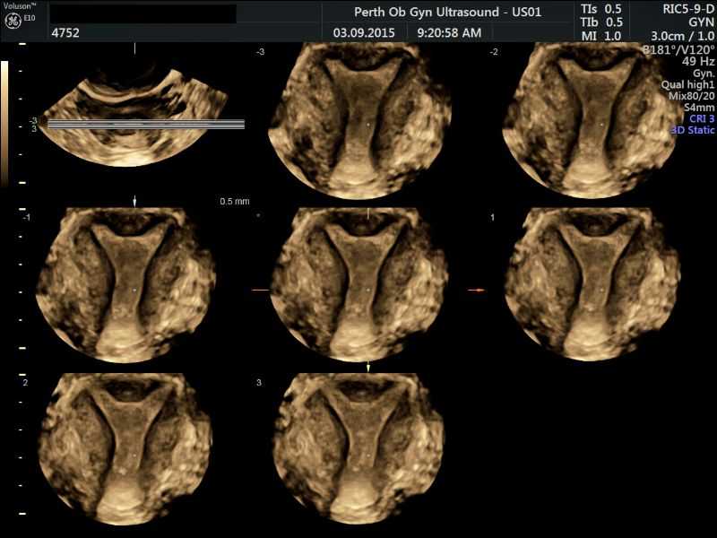 Pelvic Ultrasound - POGU